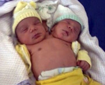 Two-Headed Baby Born in Brazil and 7 Other Strange Birth Defects ...